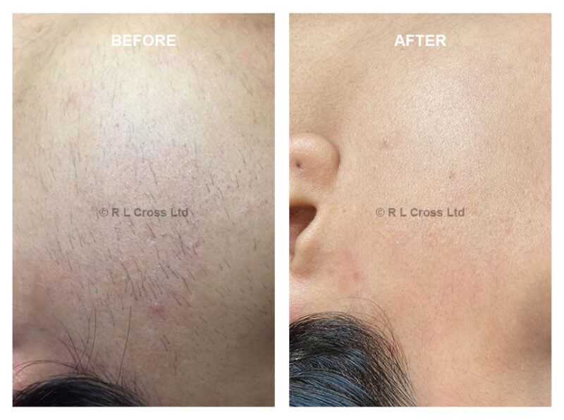 Before & After Electrolysis Treatment | RACHEL LOUISE CROSS