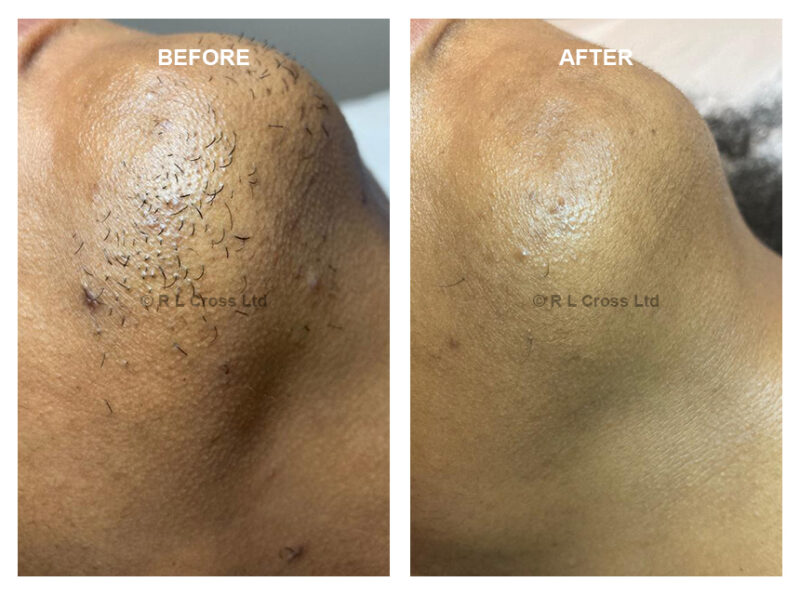 Before & After Electrolysis Treatment | RACHEL LOUISE CROSS